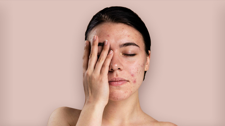 Blood Filled Pimples: Causes, Treatments, Prevention Tips - FMS SKIN