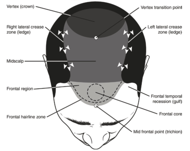 FMS HAIR - Best Hair transplant clinic in Hyderabad India