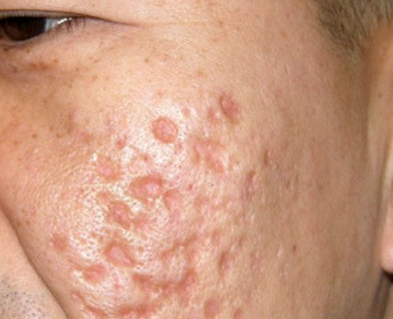 Box Scars | Acne Scars Treatment | FMS Skin & Hair Clinics