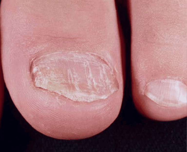 Nail Psoriasis | Psoriasis Treatment | FMS Skin & Hair Clinics