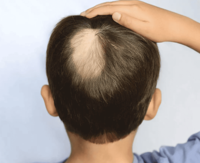 Childhood Alopecia | Hair Loss Treatment | FMS Skin & Hair Clinics