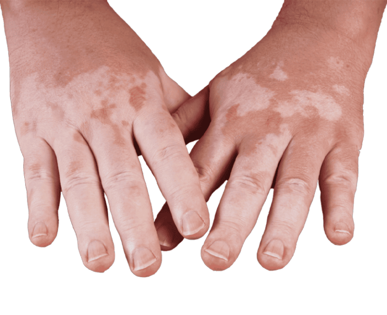 Childhood Vitiligo | Vitiligo Treatment | FMS Skin & Hair Clinics